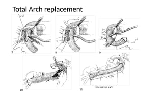 Aortic arch aneurysms in vascular surgery | PPTX