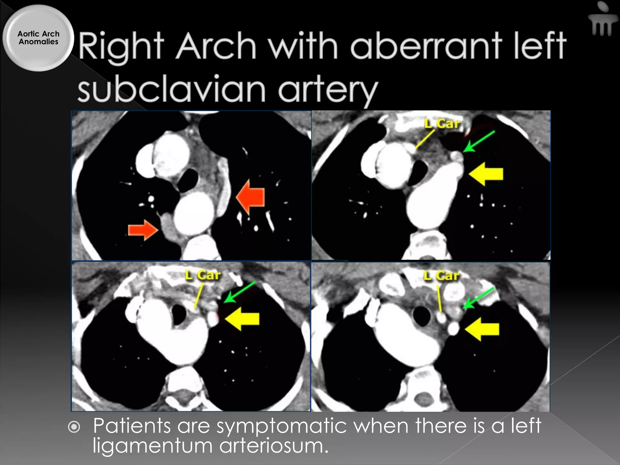 Aortic arch anomalies | PDF