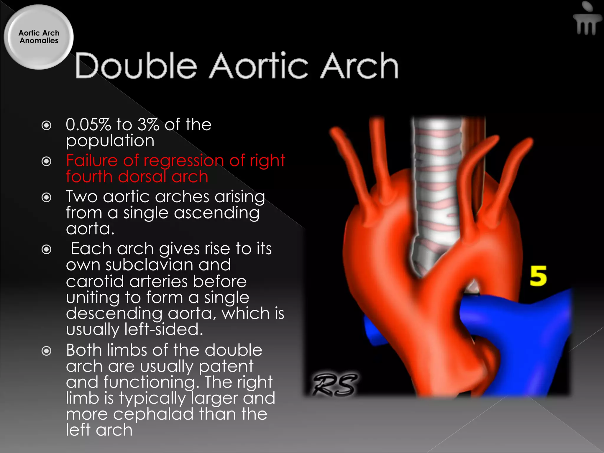 Aortic arch anomalies | PDF