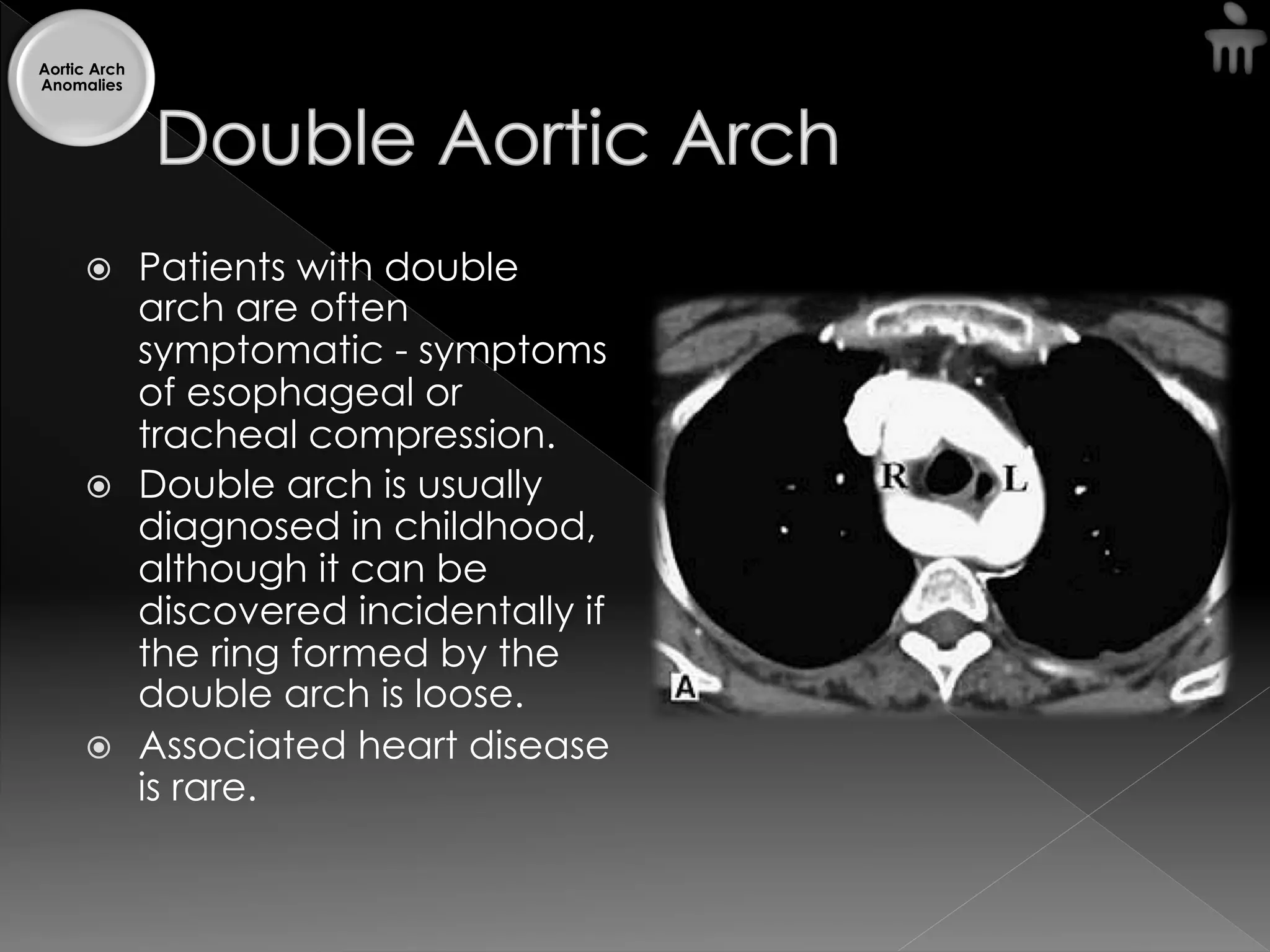 Aortic arch anomalies | PDF
