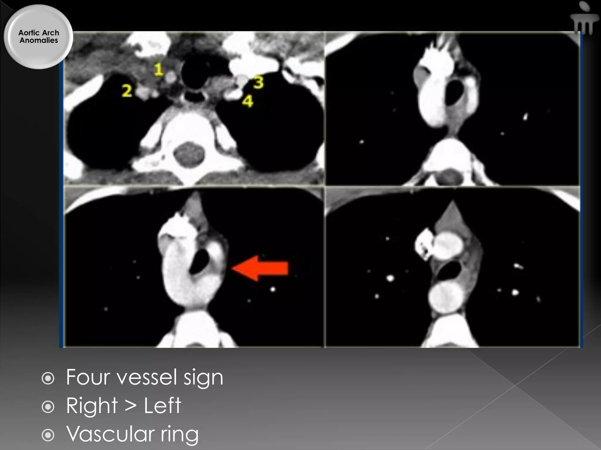 Aortic arch anomalies | PDF