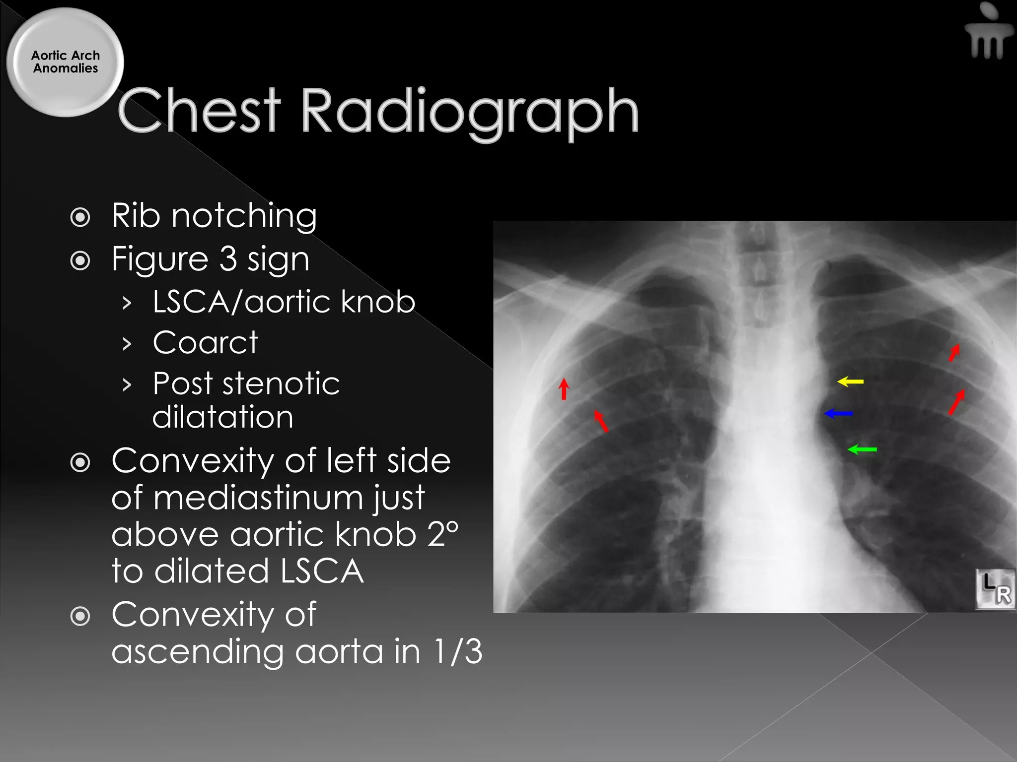 Aortic arch anomalies | PDF