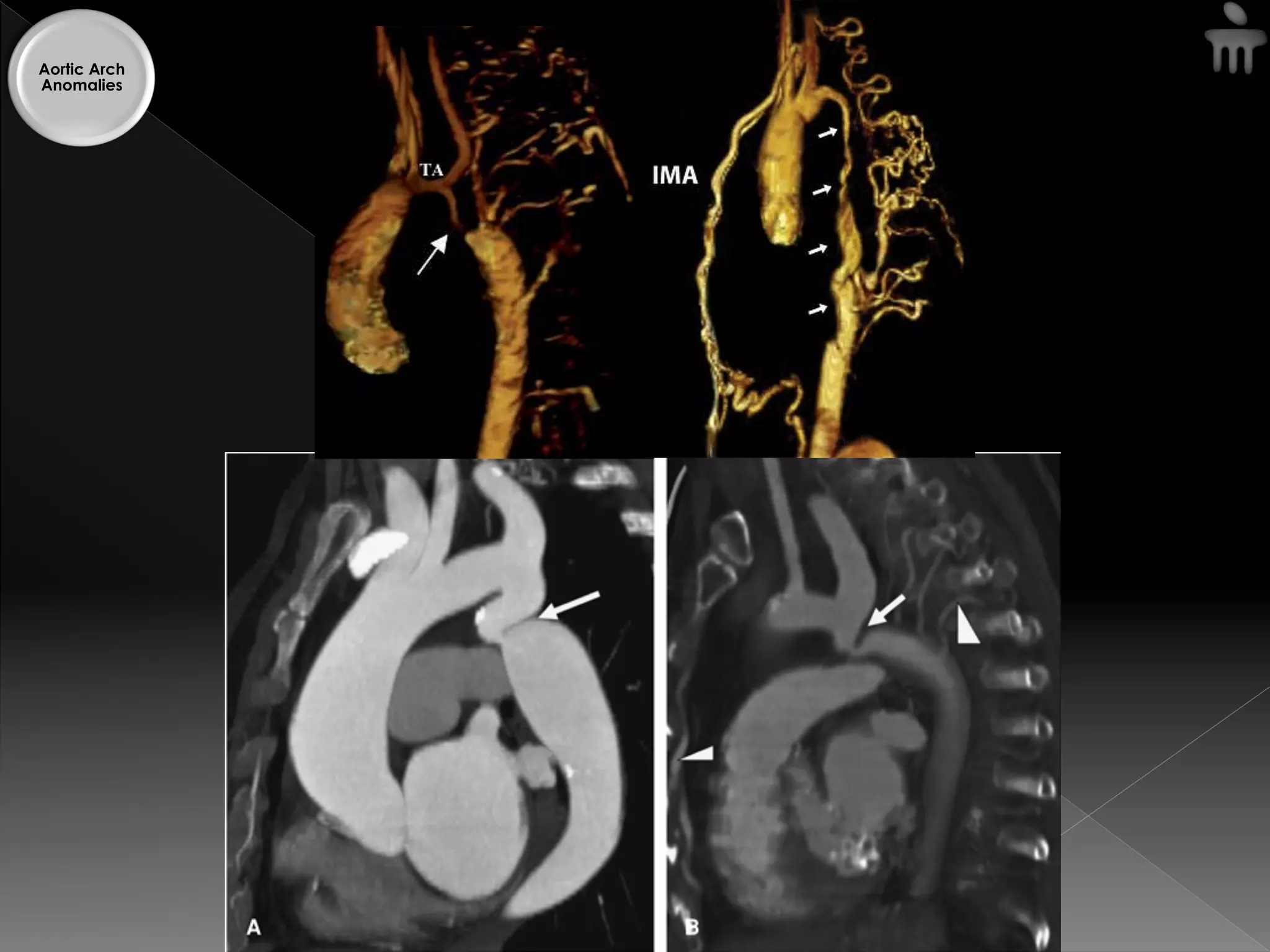 Aortic arch anomalies | PDF