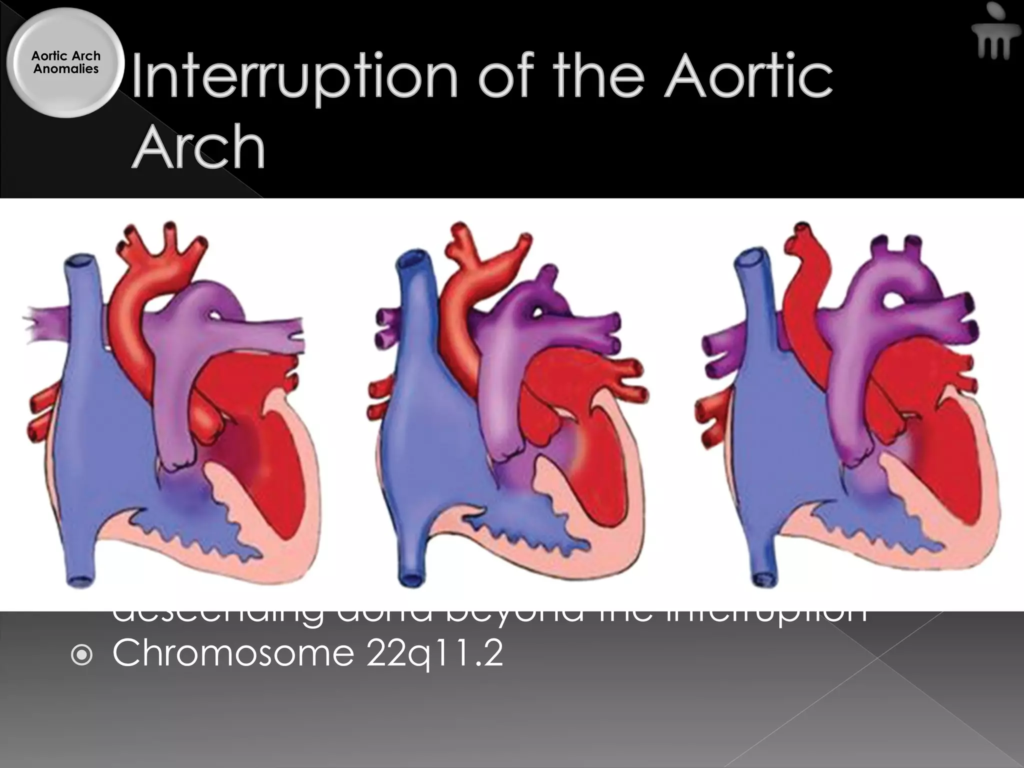 Aortic arch anomalies | PDF
