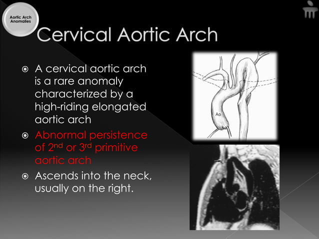 Aortic arch anomalies | PDF