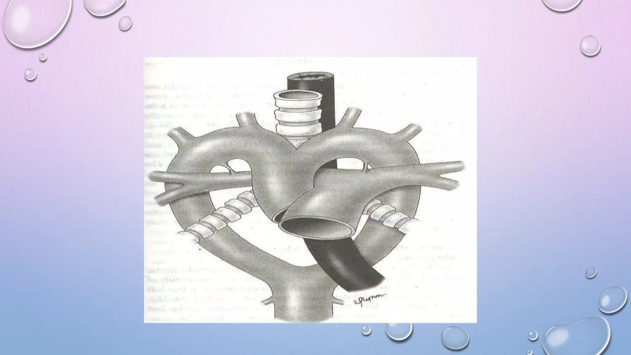 Aortic arch anomalies | PPTX | Heart and Cardiovascular Diseases ...