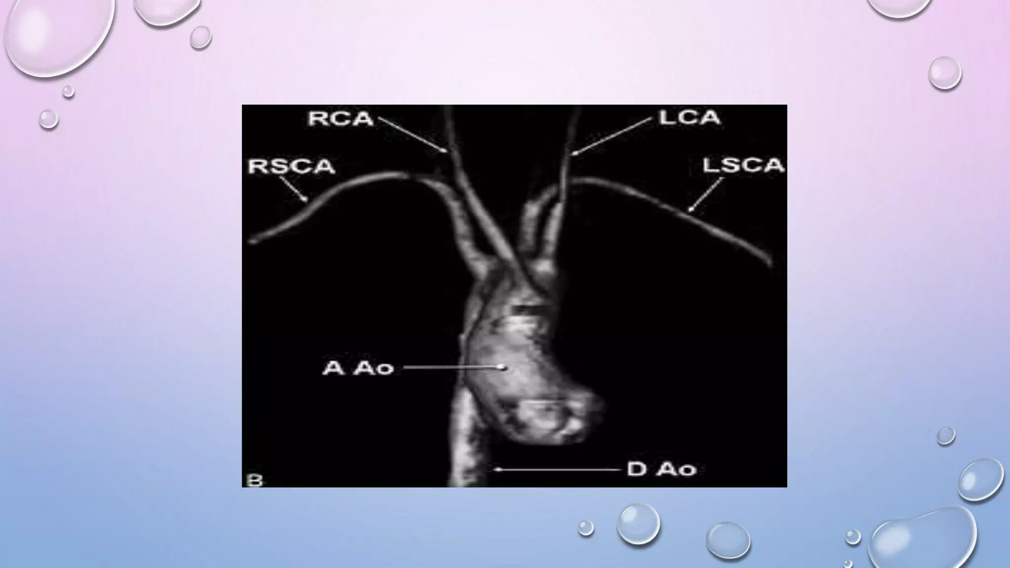 Aortic arch anomalies | PPTX | Heart and Cardiovascular Diseases ...