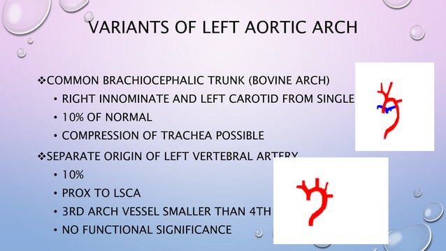 Aortic arch anomalies | PPTX | Heart and Cardiovascular Diseases ...