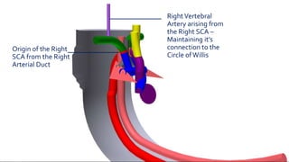 Aortic arch anomalies | PPTX