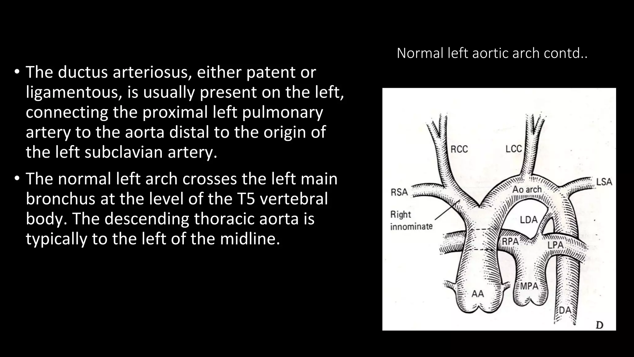 AORTIC ARCH ANOMALIES 2.pptx