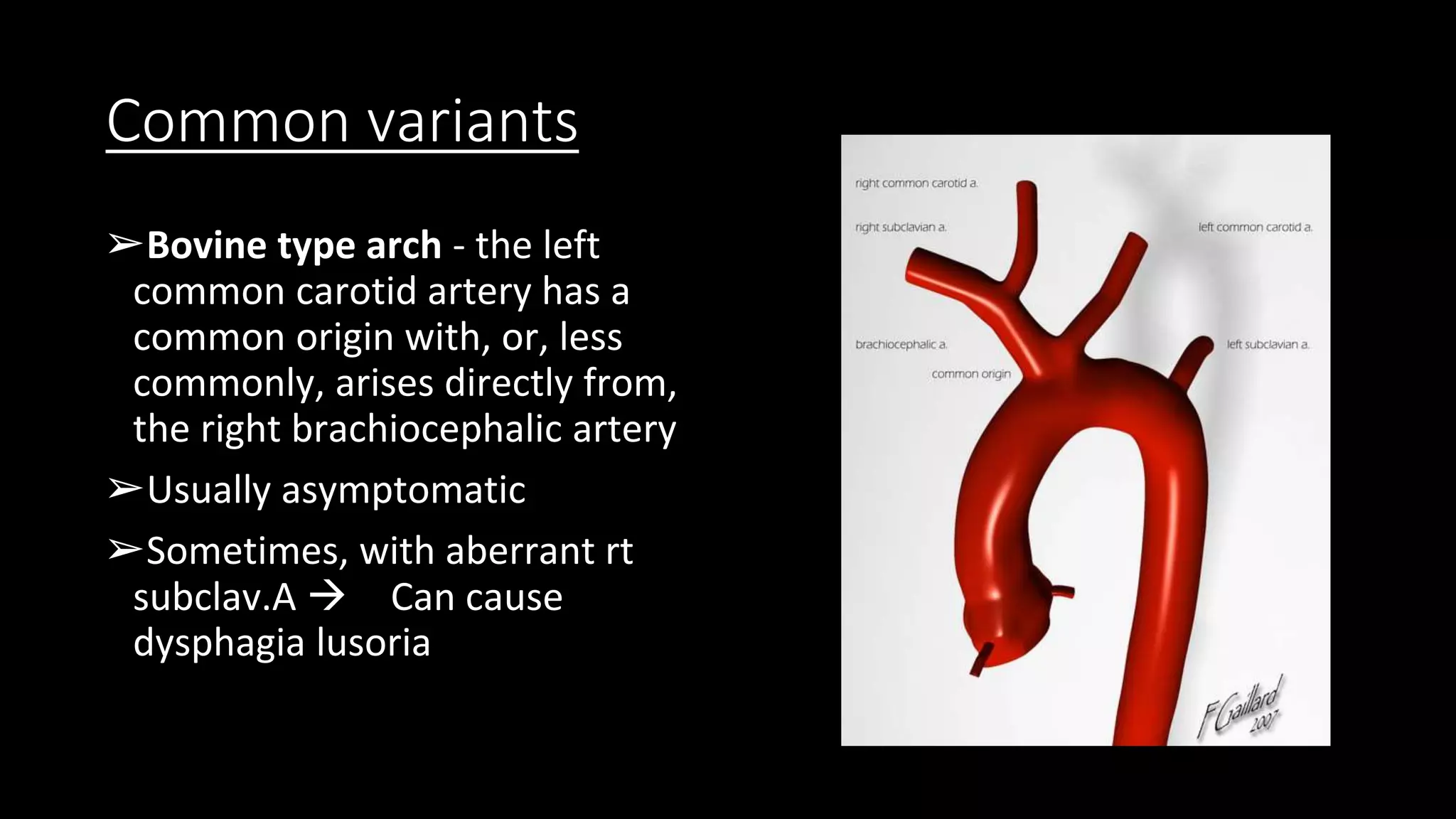 AORTIC ARCH ANOMALIES 2.pptx