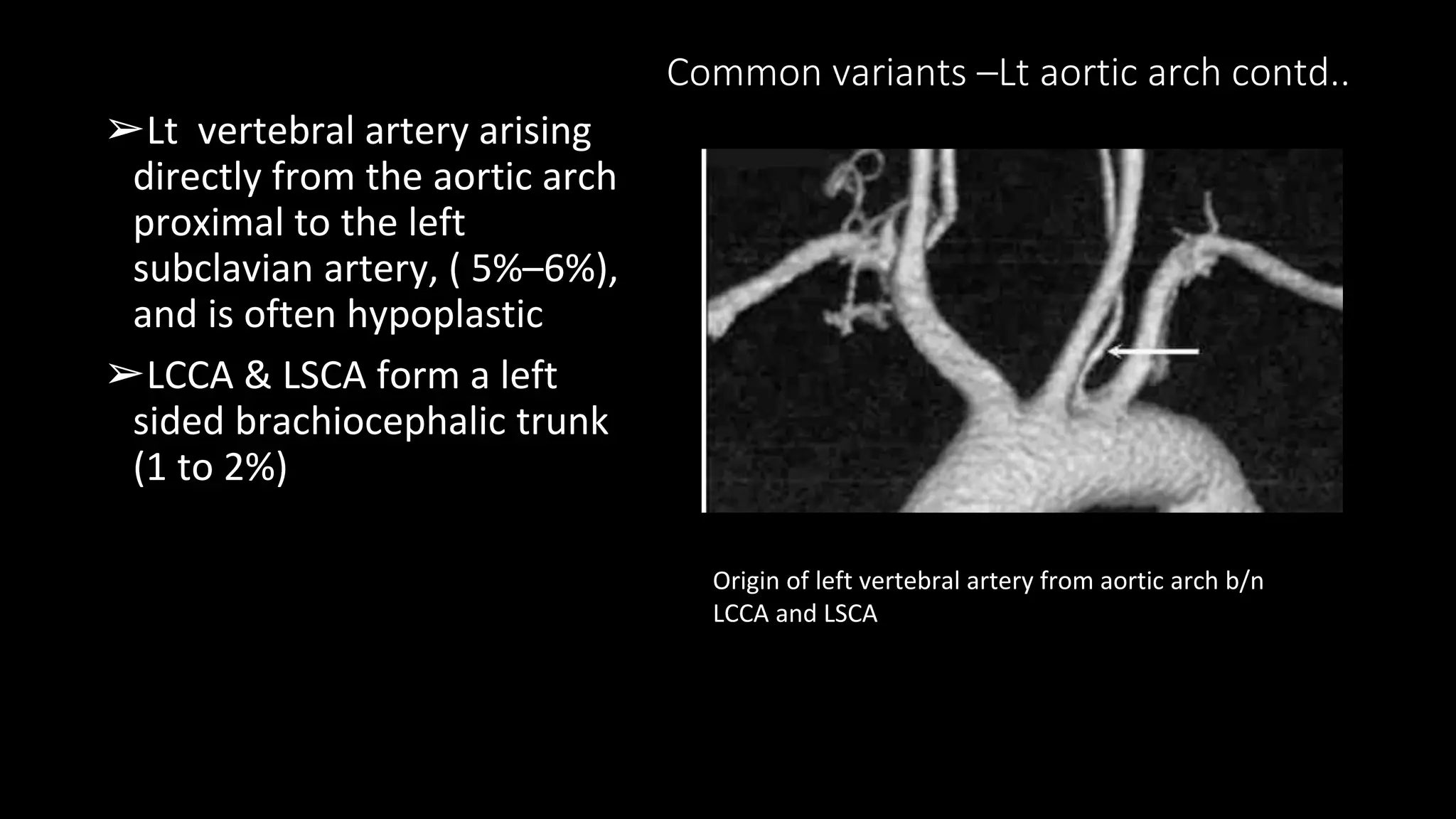 AORTIC ARCH ANOMALIES 2.pptx