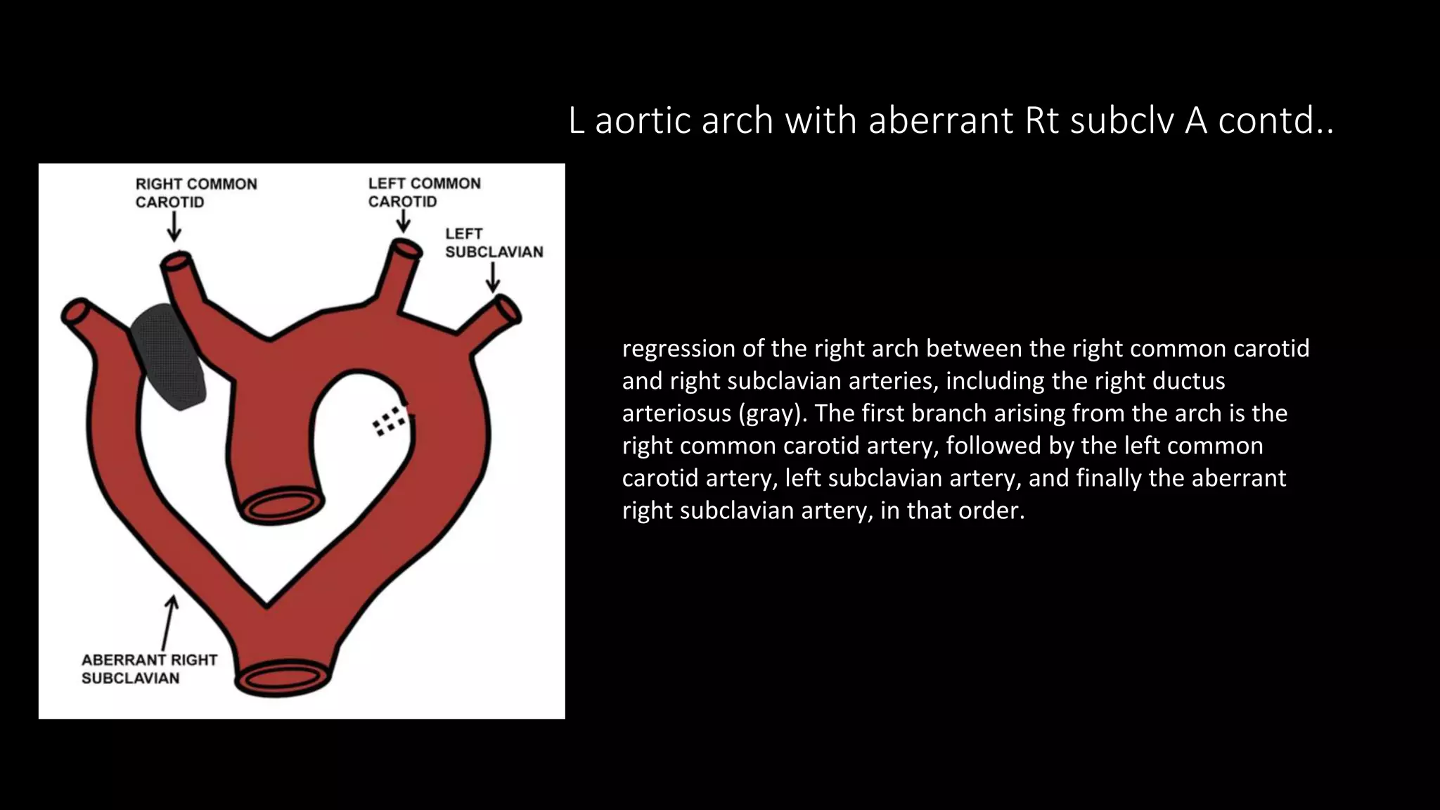 AORTIC ARCH ANOMALIES 2.pptx