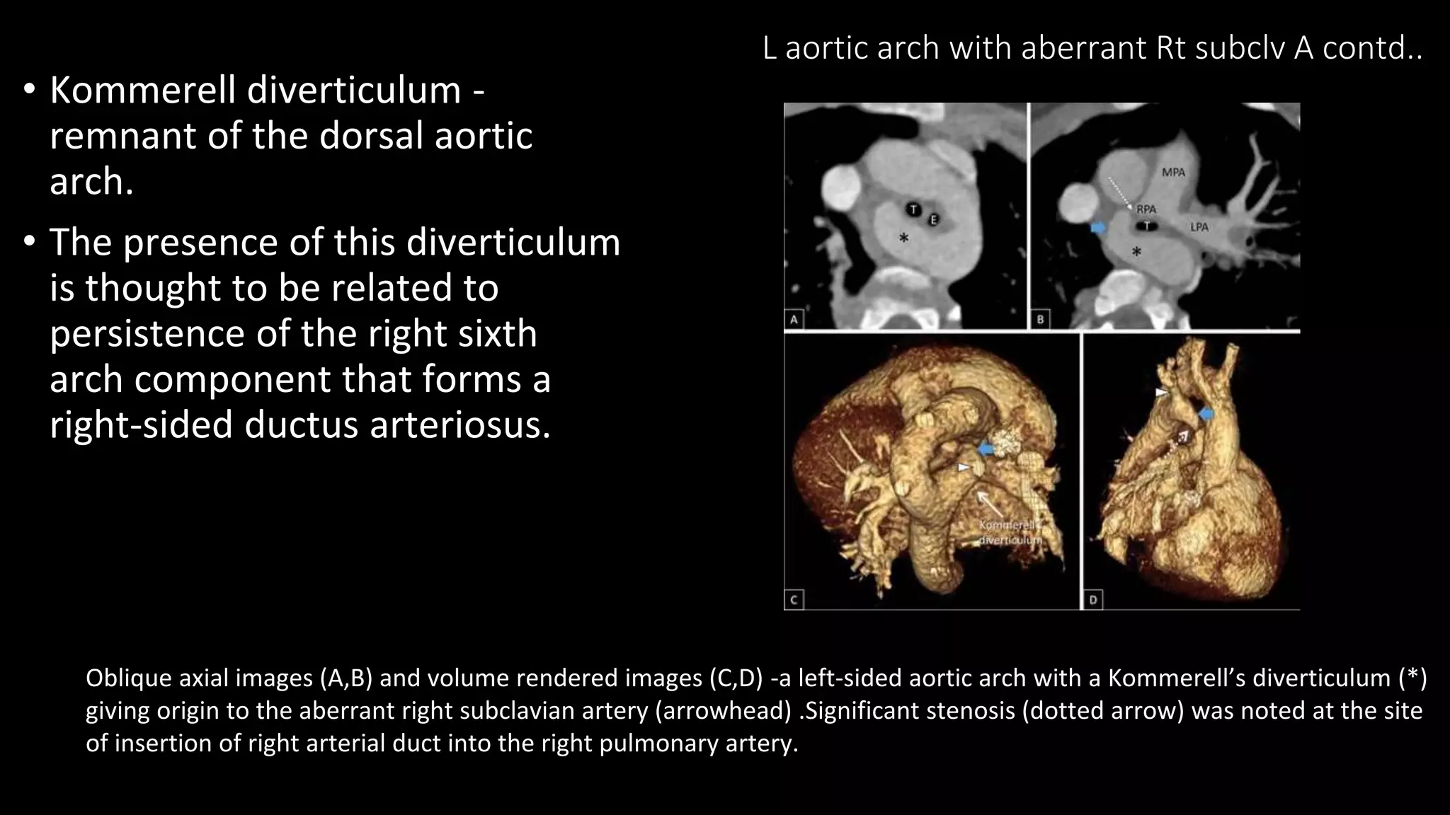 AORTIC ARCH ANOMALIES 2.pptx