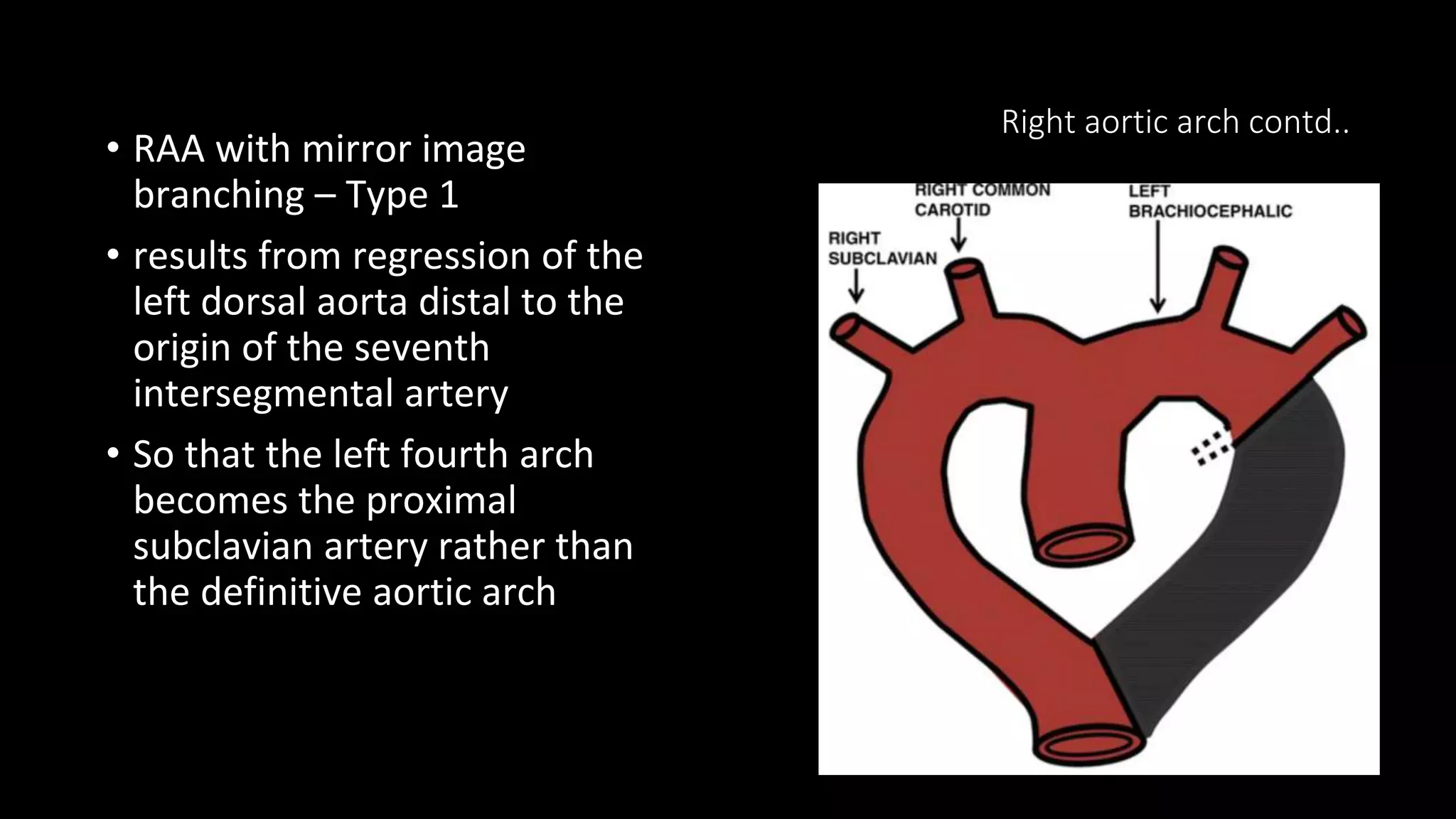 AORTIC ARCH ANOMALIES 2.pptx