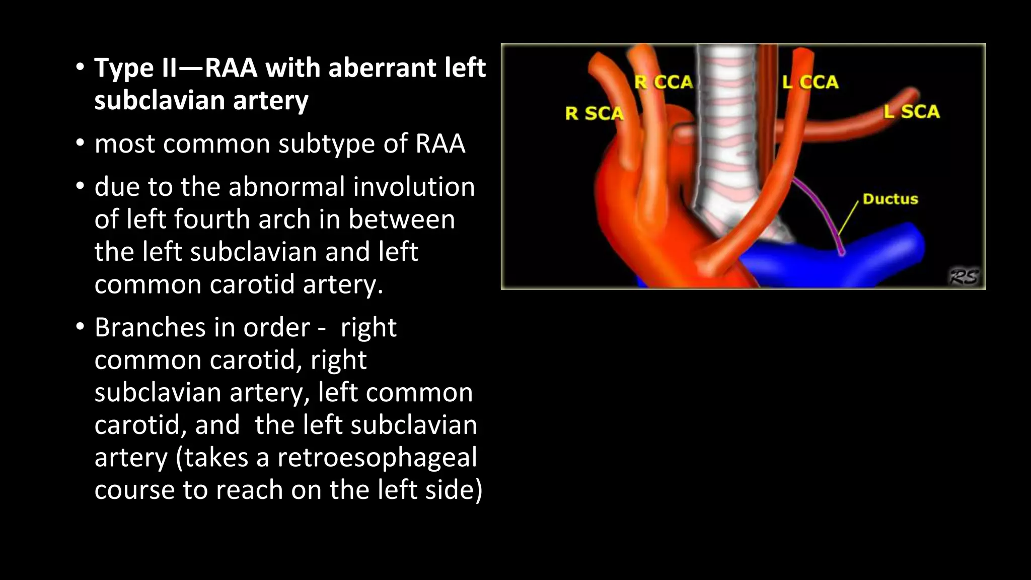 AORTIC ARCH ANOMALIES 2.pptx