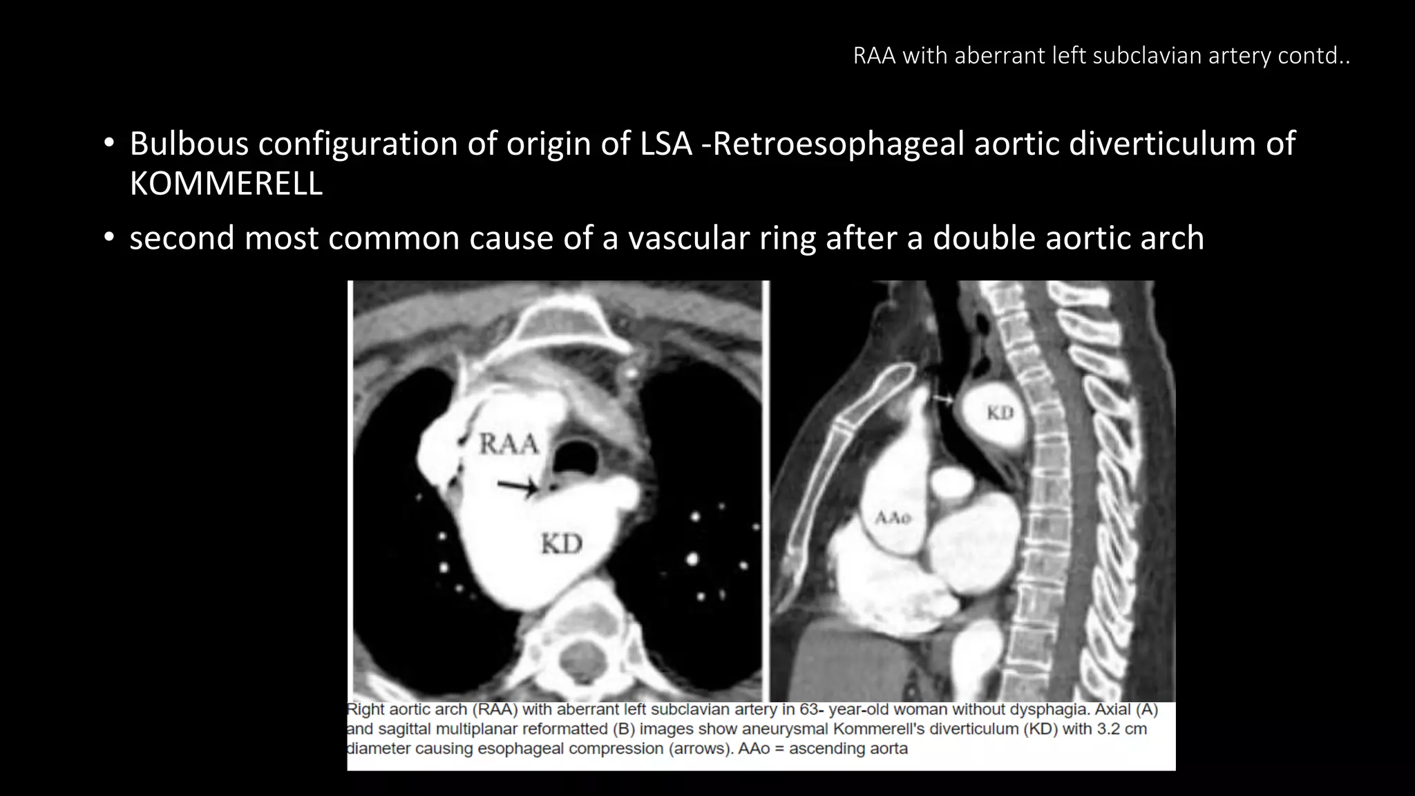 AORTIC ARCH ANOMALIES 2.pptx