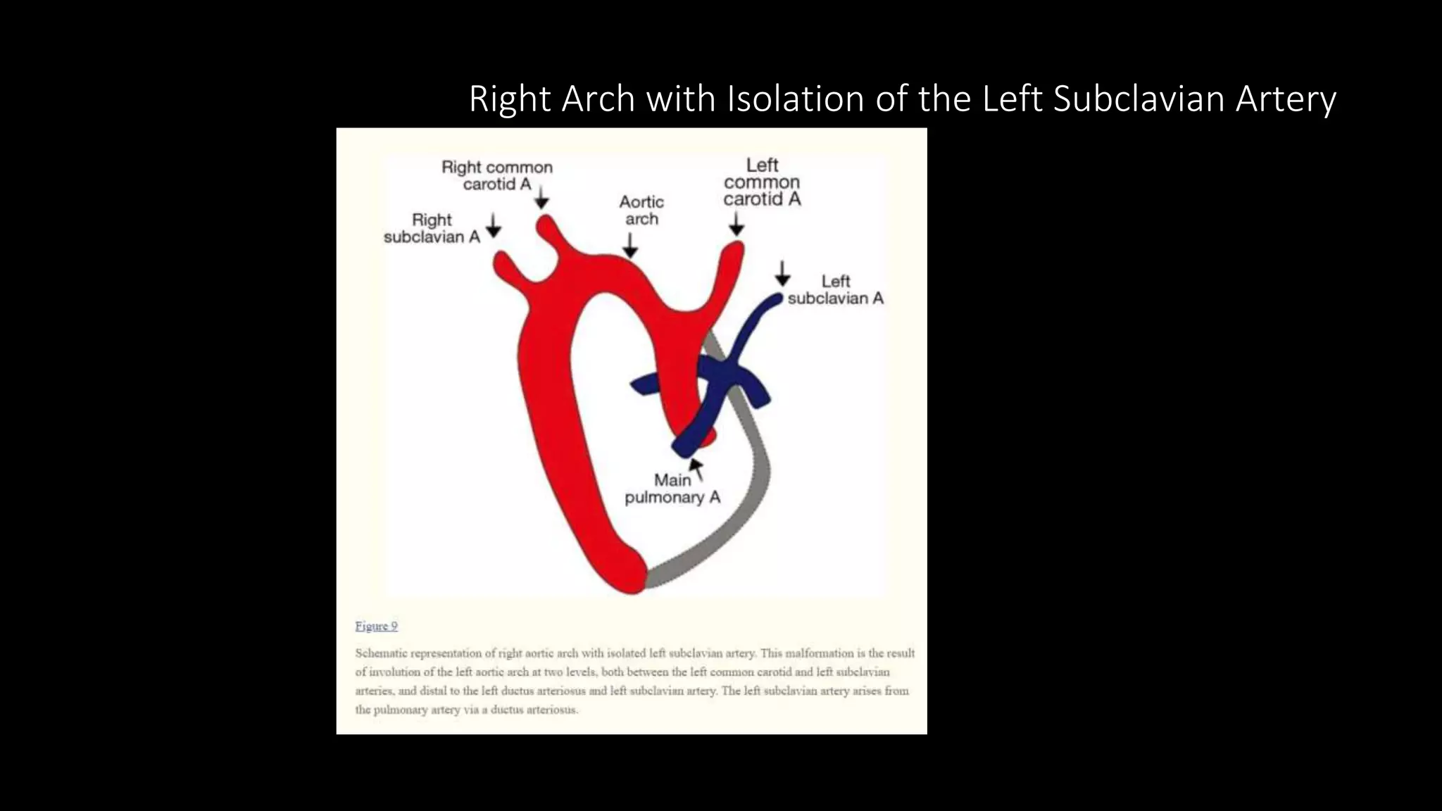 AORTIC ARCH ANOMALIES 2.pptx