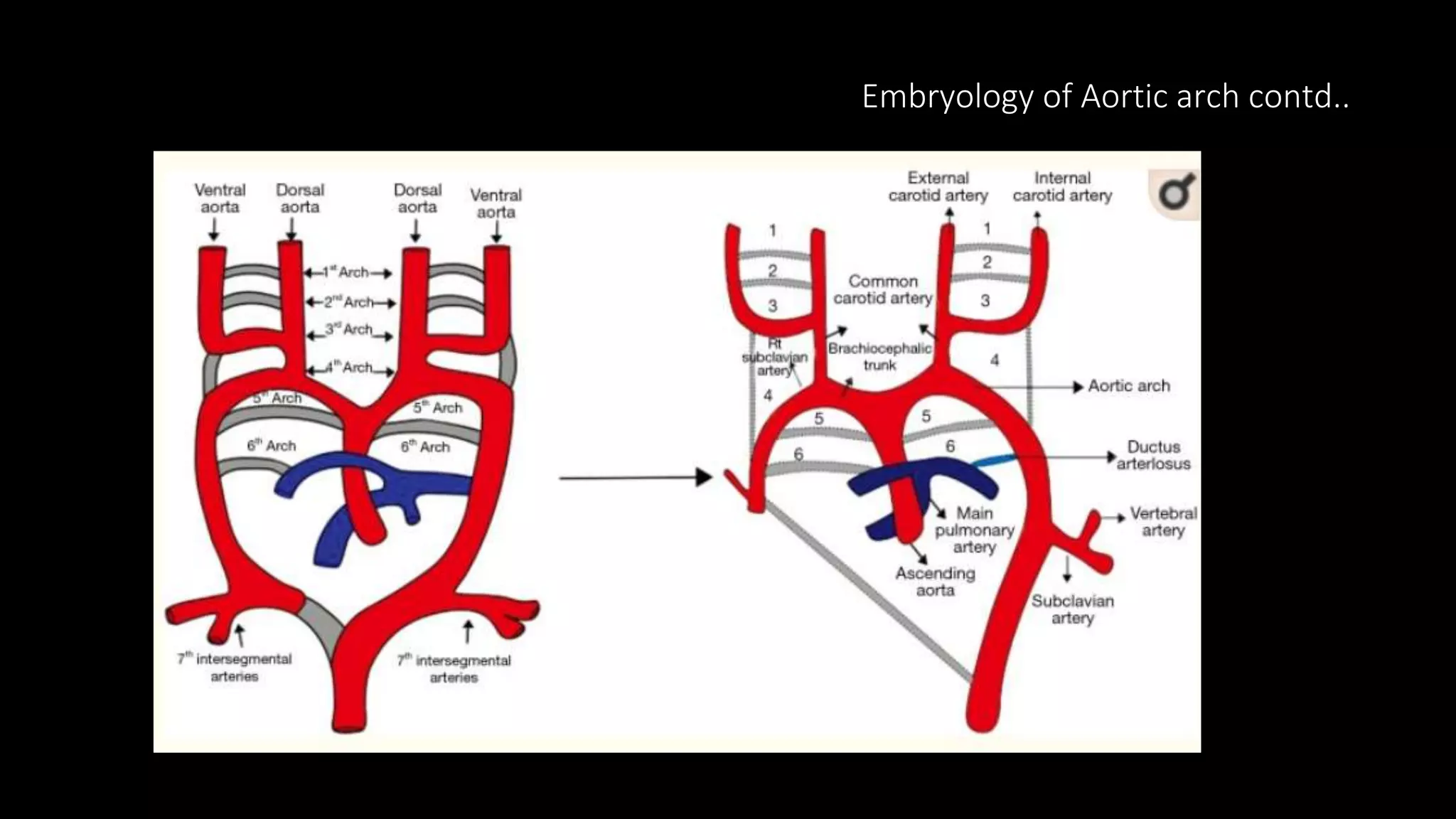 AORTIC ARCH ANOMALIES 2.pptx