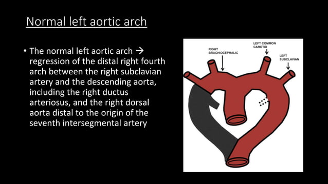 AORTIC ARCH ANOMALIES 2.pptx | Heart and Cardiovascular Diseases ...