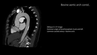 AORTIC ARCH ANOMALIES 2.pptx