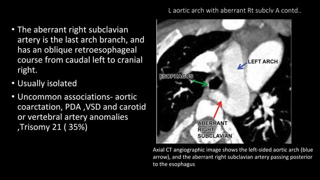 AORTIC ARCH ANOMALIES 2.pptx | Heart and Cardiovascular Diseases ...