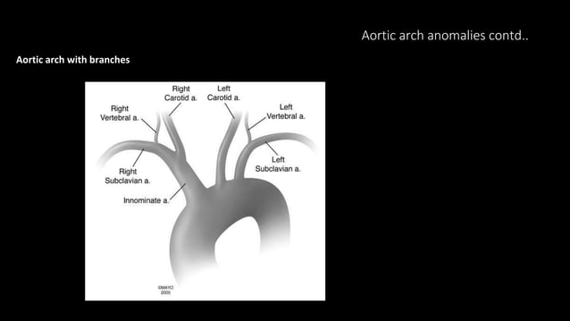 AORTIC ARCH ANOMALIES 2.pptx | Heart and Cardiovascular Diseases ...