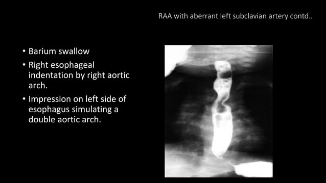 AORTIC ARCH ANOMALIES 2.pptx | Heart and Cardiovascular Diseases ...