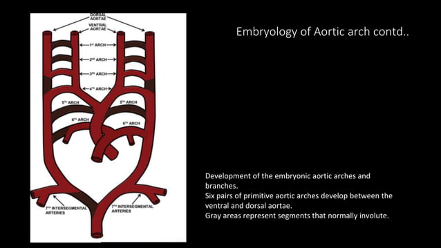 AORTIC ARCH ANOMALIES 2.pptx | Heart and Cardiovascular Diseases ...