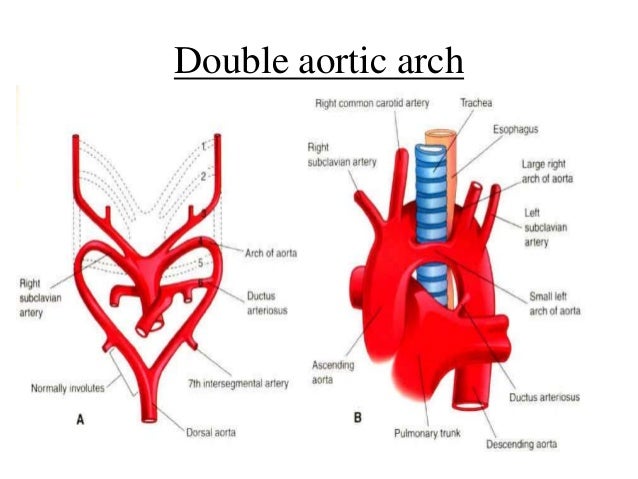 Aortic arches