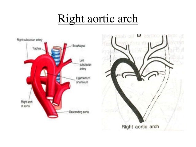 Aortic arches