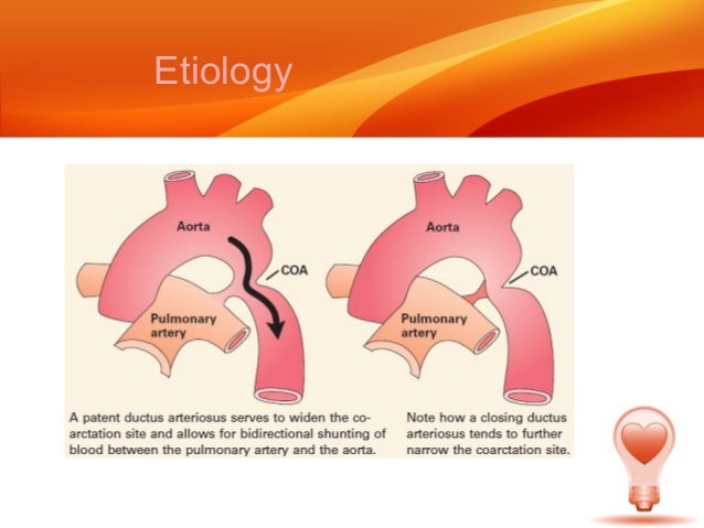 Aortic coarctation - Khaled Ghanem MD