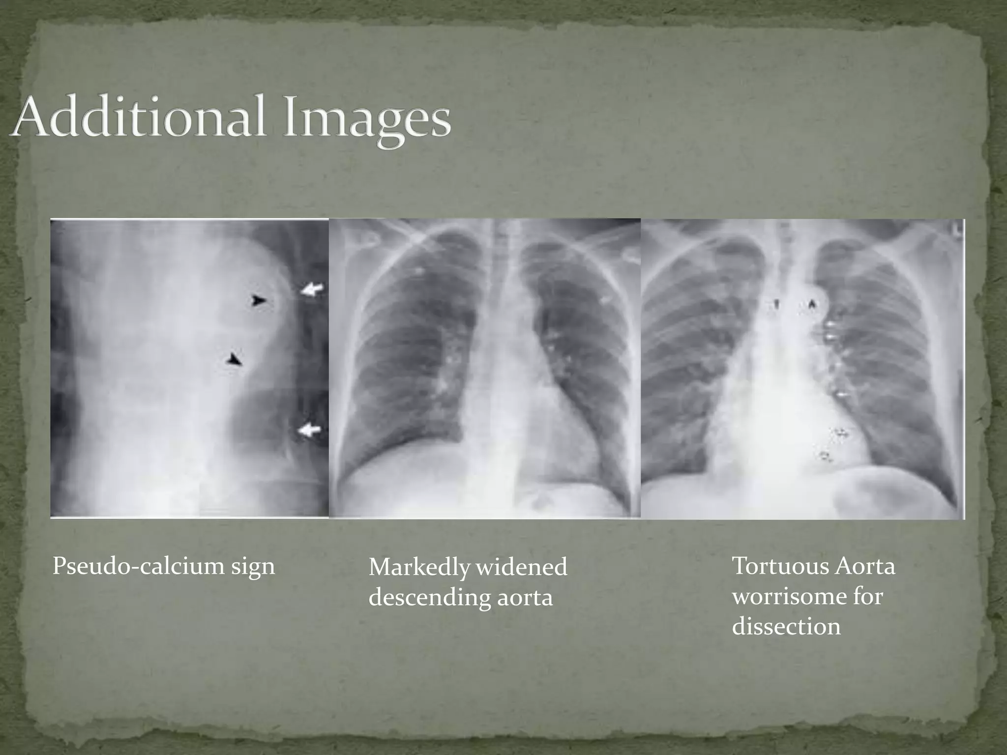 Aortic dissection | PPTX