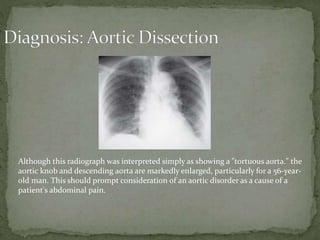 Aortic dissection | PPT