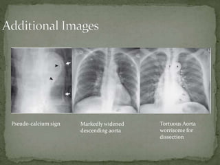 Aortic dissection | PPT