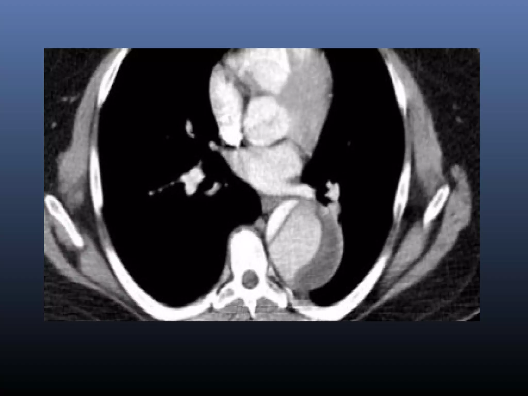 Imaging of Aortic Dissection | PPT