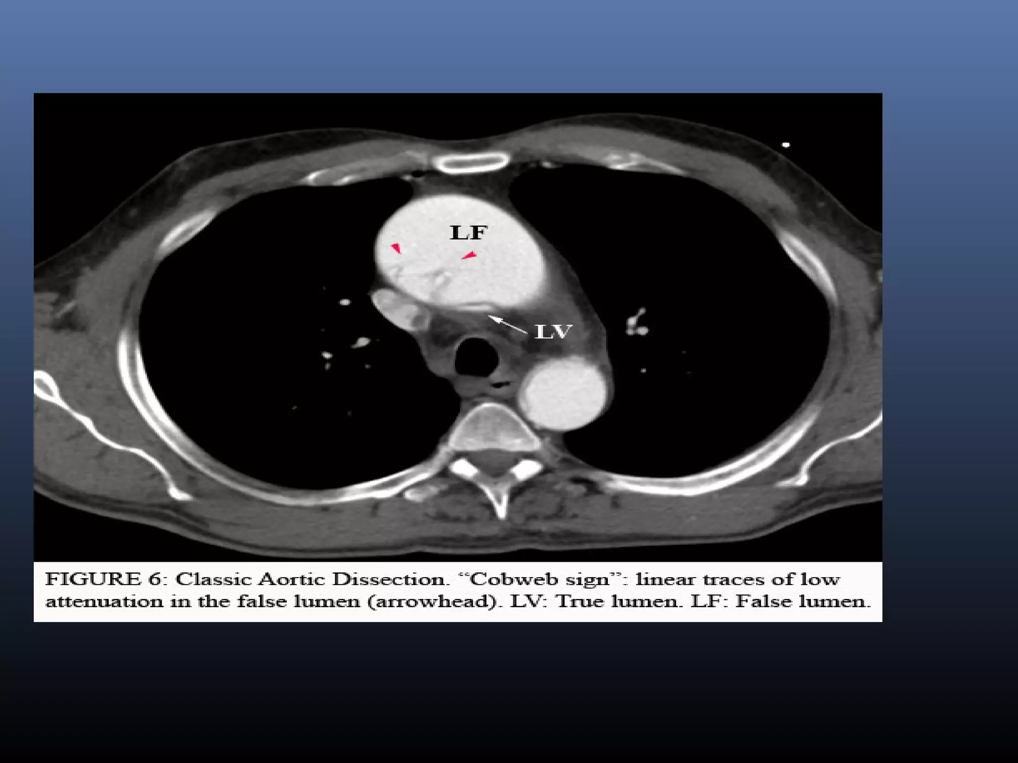 Imaging of Aortic Dissection | PPT