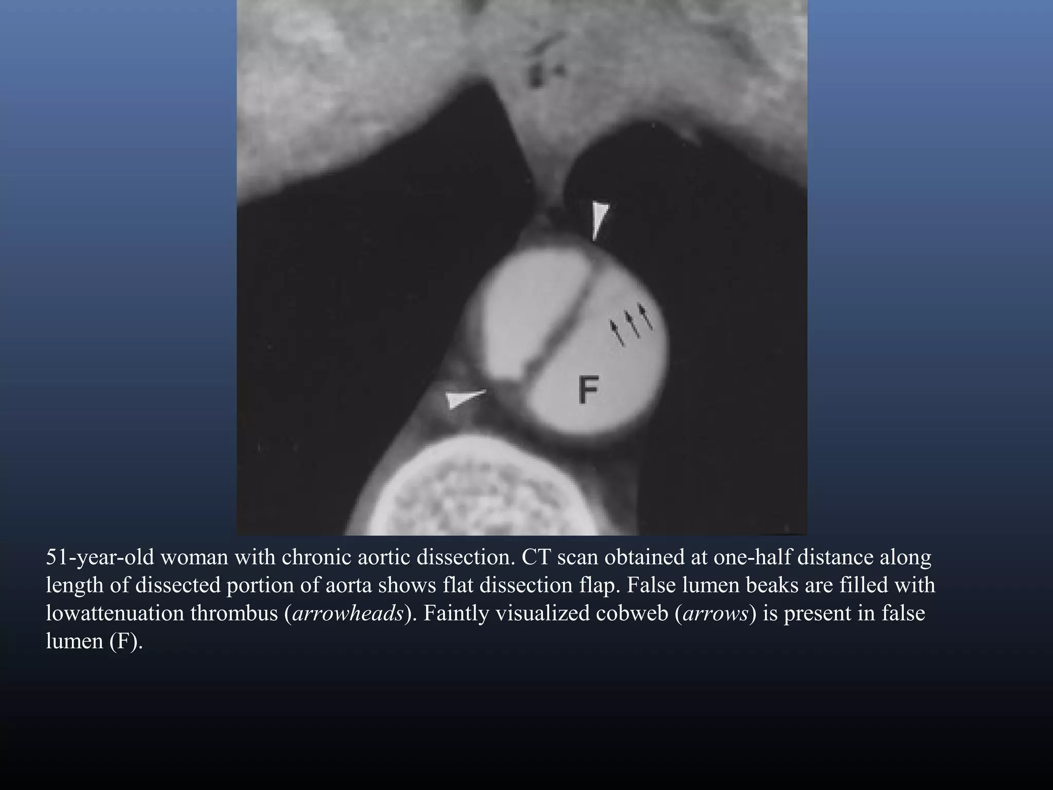 Imaging of Aortic Dissection | PPT