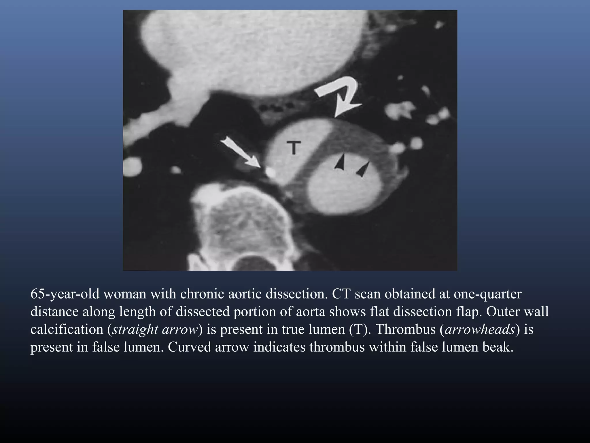 Imaging of Aortic Dissection | PPT