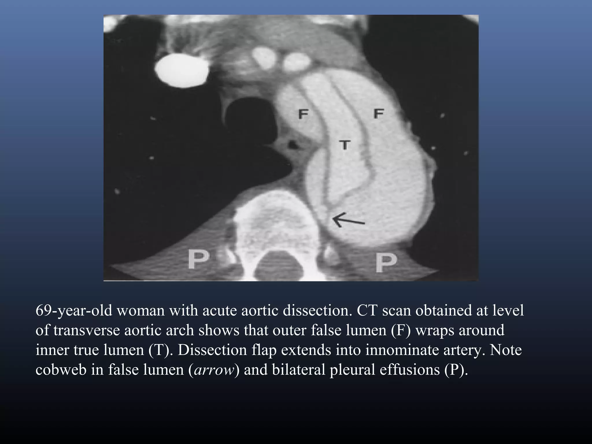 Imaging of Aortic Dissection | PPT