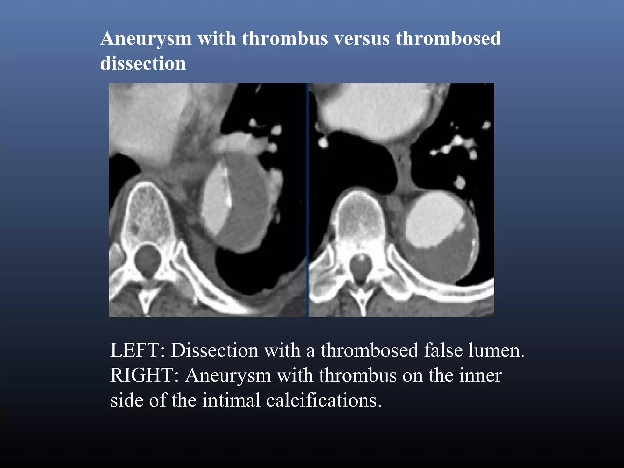 Imaging of Aortic Dissection | PPT