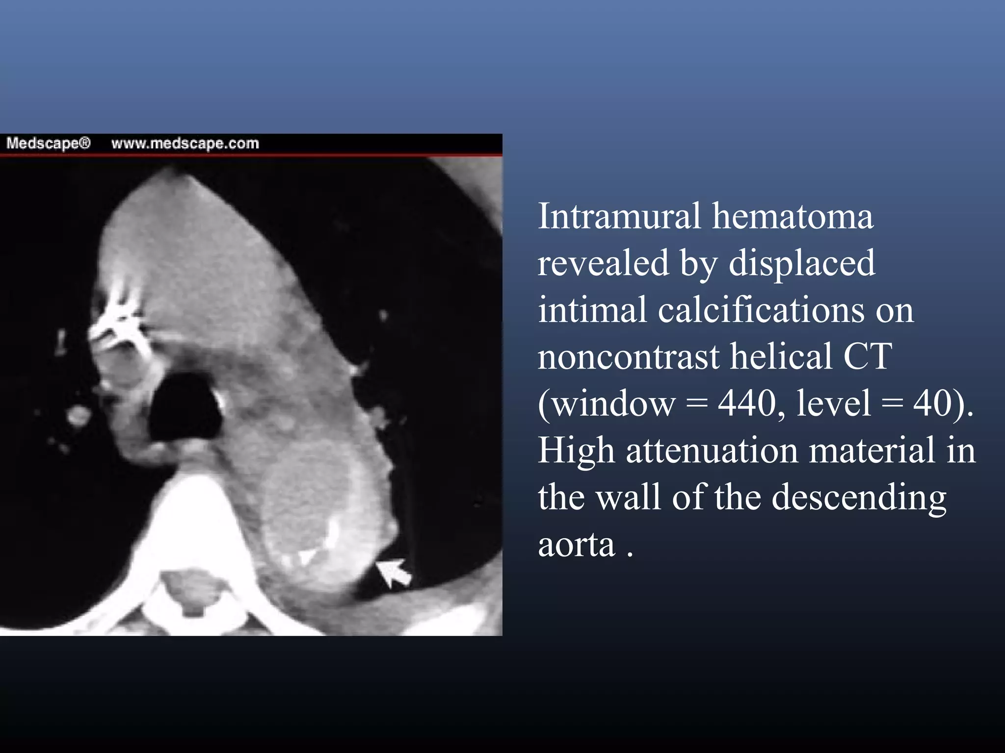 Imaging of Aortic Dissection | PPT