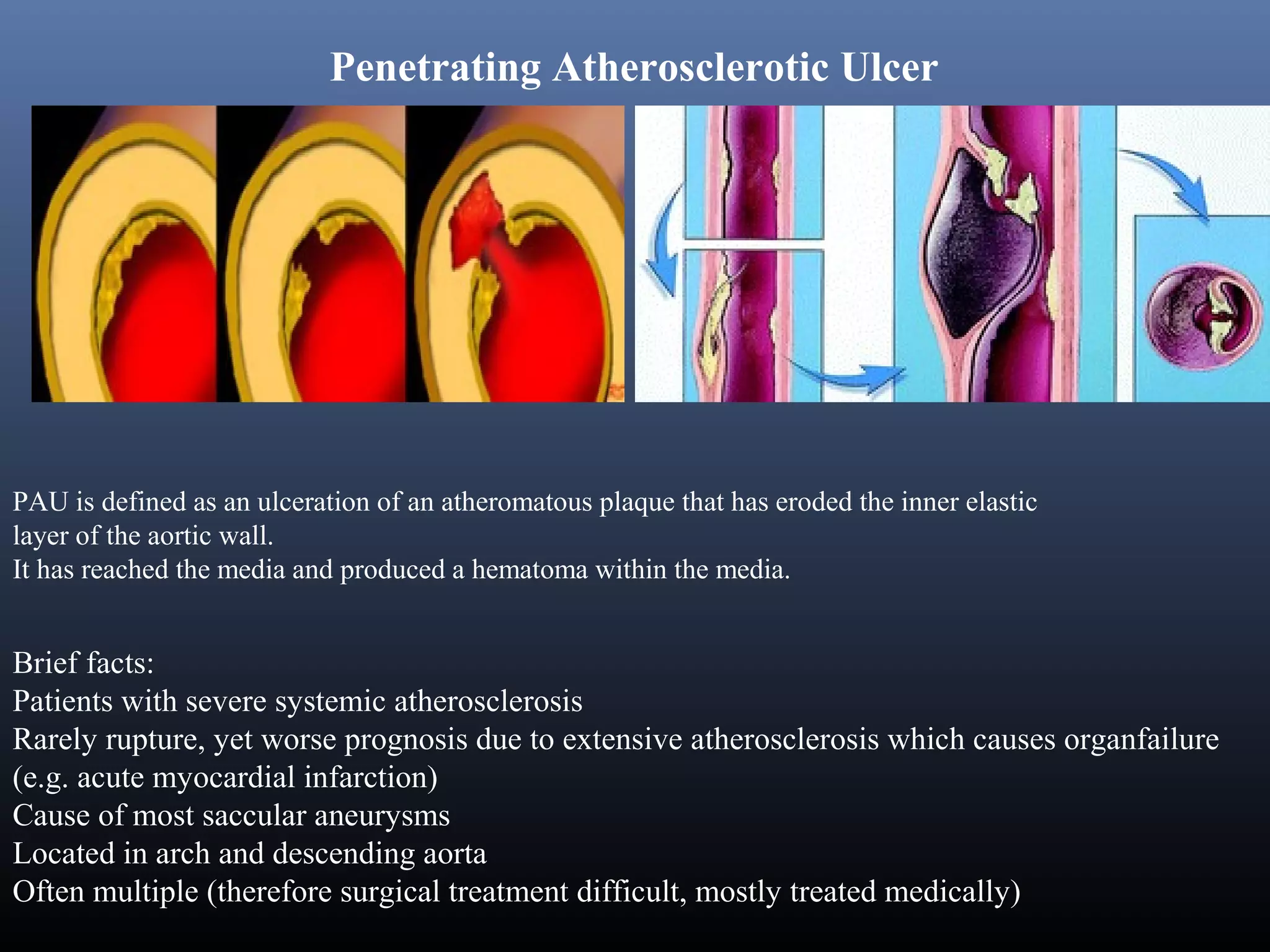Imaging of Aortic Dissection | PPT