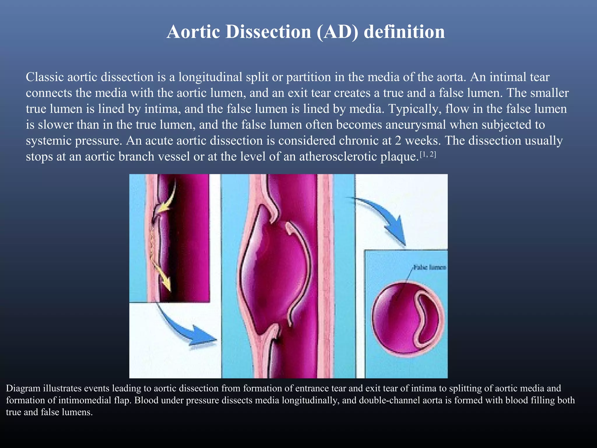 Imaging of Aortic Dissection | PPT