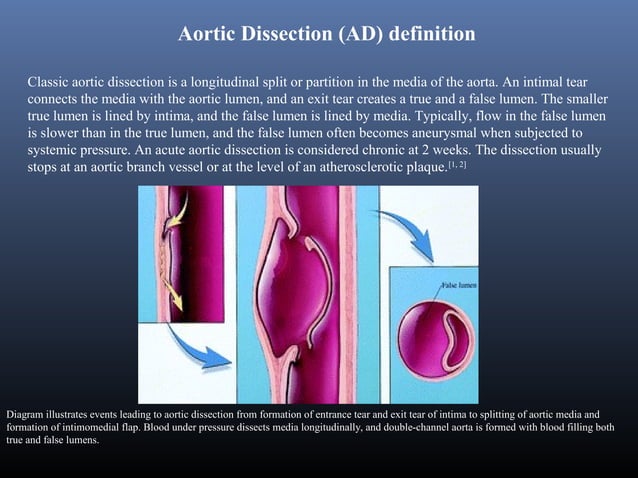 Imaging of Aortic Dissection | PPT