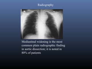 Aortic Dissection X Ray