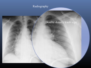 Aortic Dissection X Ray