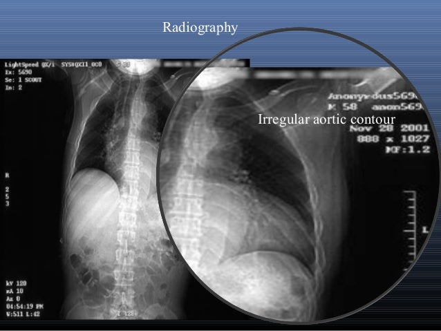 Imaging of Aortic Dissection