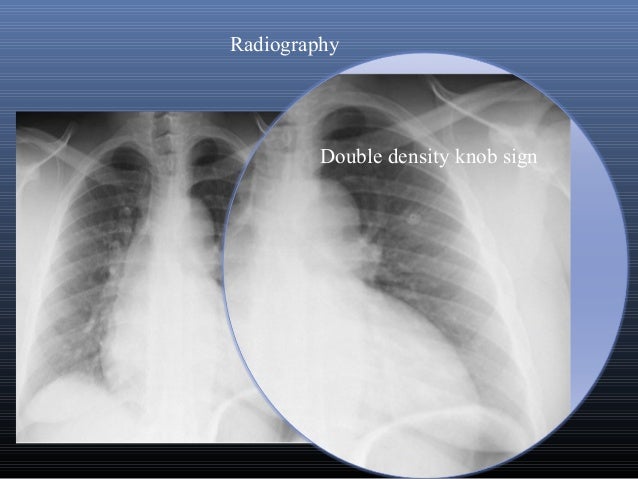 Imaging of Aortic Dissection