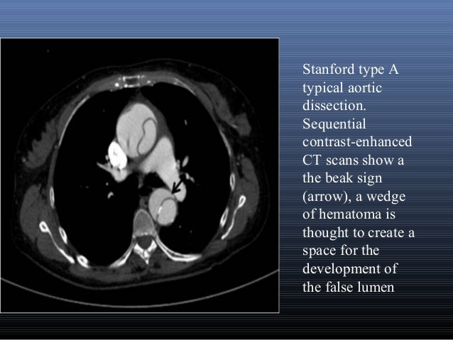 Imaging of Aortic Dissection